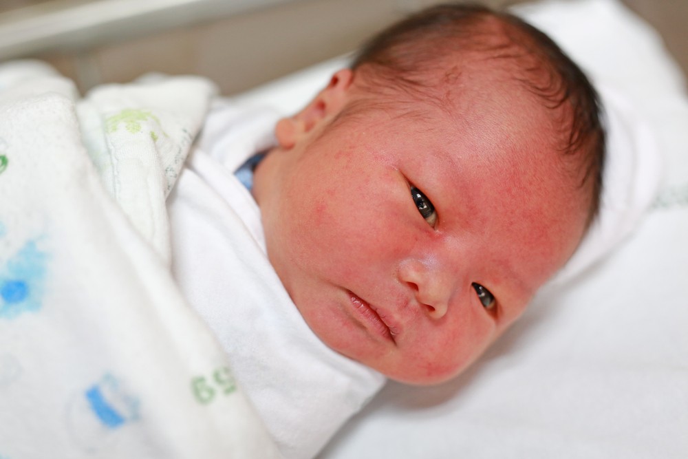 Bubițe pe față la bebeluși: Soluții pentru acneea neonatală