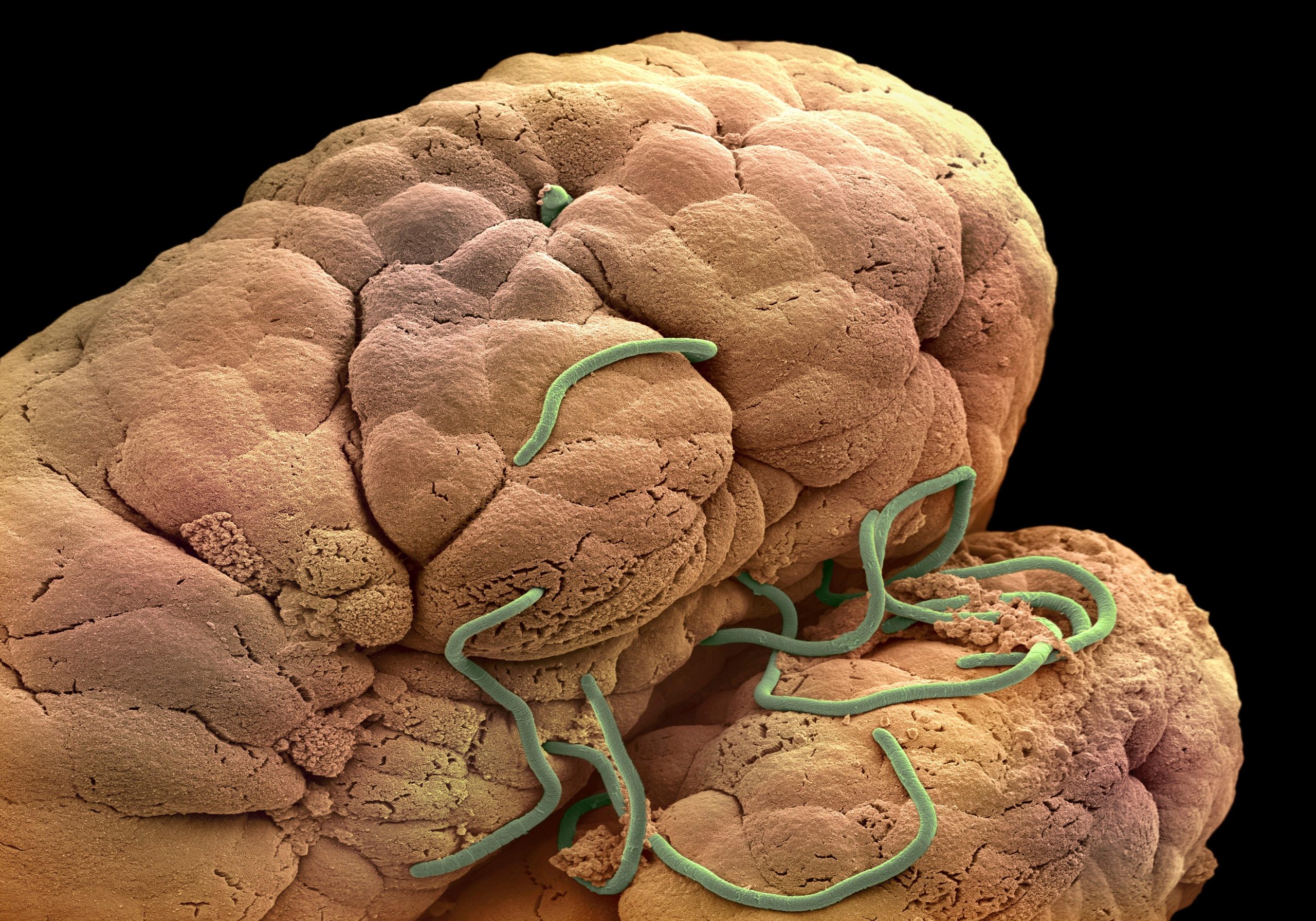 Infestare cu oxiuri la copii: Simptome și tratament
