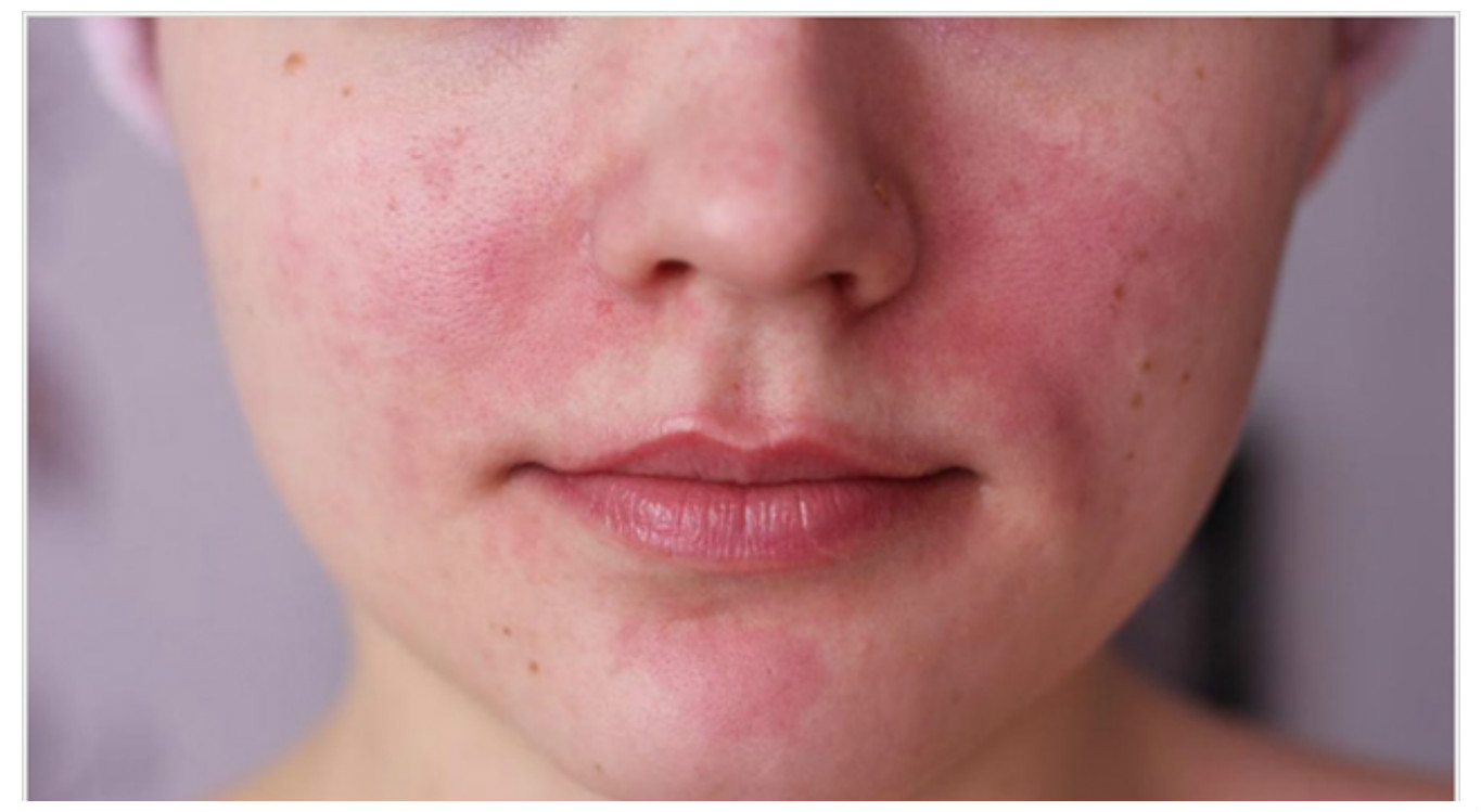 Pete roșii pe față poze: Cum să ameliorezi rapid disconfortul