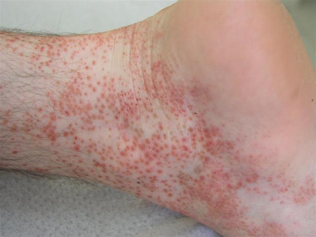 Peteșii punctiforme. Cauze, forme clinice, tratament, poze • Buna Ziua ...