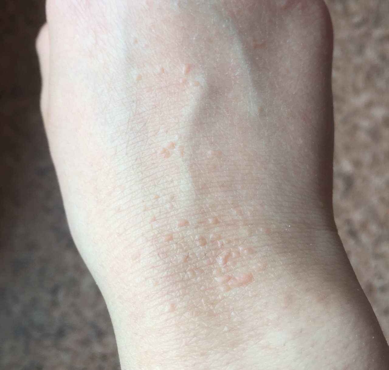 Bubițe pe mâini poze. Factorii care influențează apariția unei probleme ...