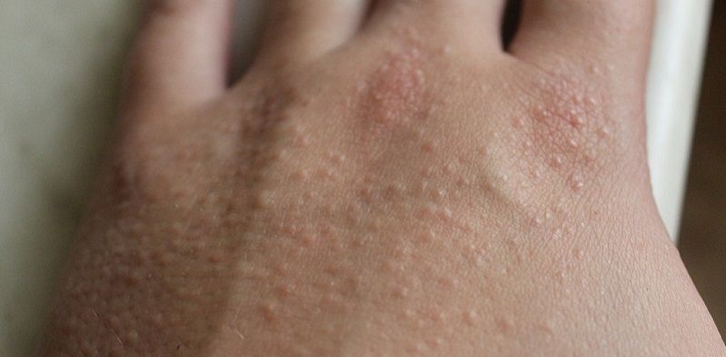 Bubițe pe mâini poze. Factorii care influențează apariția unei probleme ...