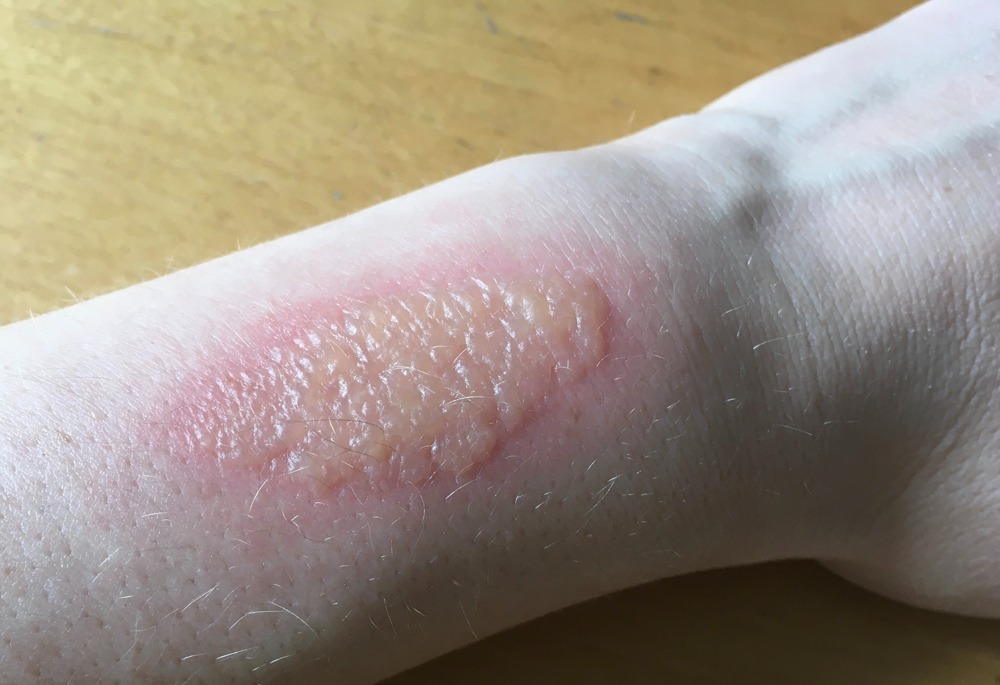 Arsuri de gradul 2 imagini. Factorii de care depinde recuperarea pielii ...