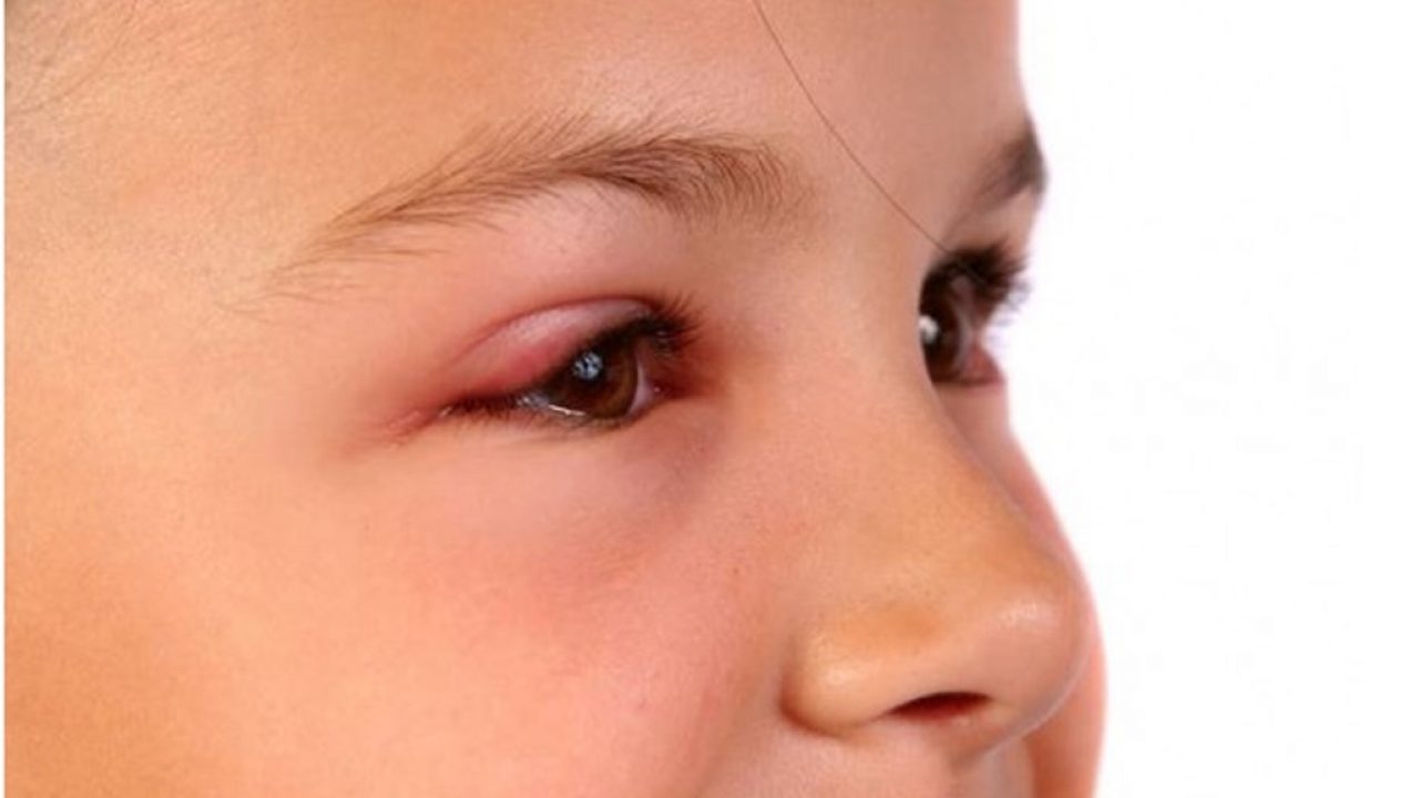 Ce simptome prezintă ulciorul la ochi și cum se tratează? Tratament ...