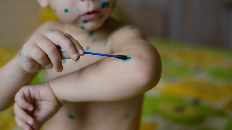 Varicela prima zi. Care sunt primele simptome provocate de virus