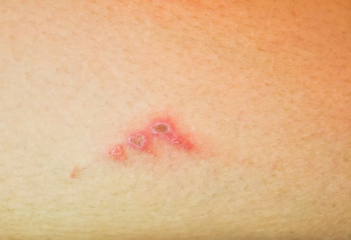 Bubițe roșii pe corp și mâncărime. Ce patologii semnalează aceste ...