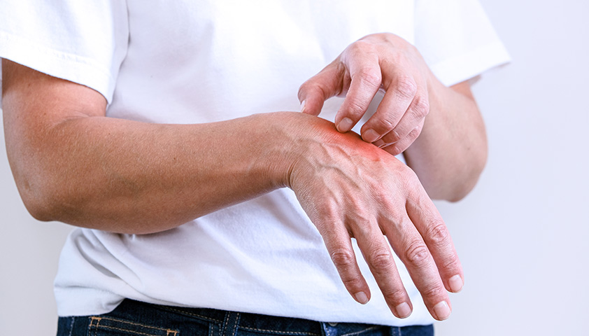 Cum arată râia? Semne observabile pentru identificarea afecțiunii de piele