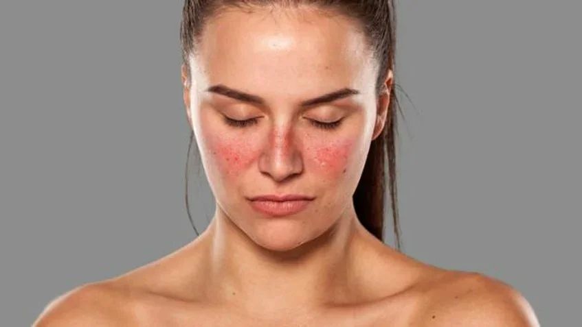 Boala lupus – poze. Cât de periculoasă este aceasta și factorii ...