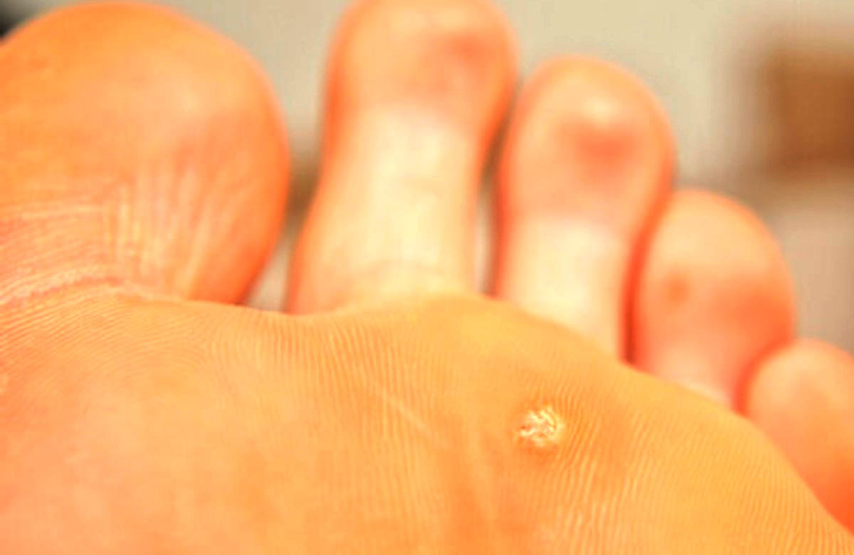 Veruca plantară. De ce virus este provocată boala?