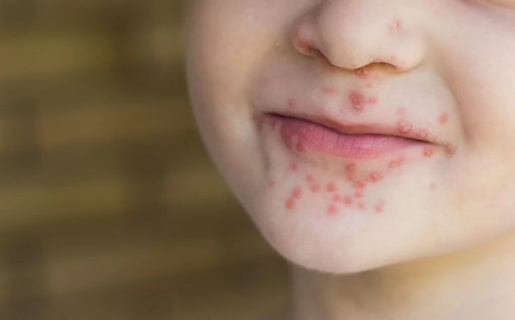 Boala sărutului – poze. Cum se manifestă afecțiunea și cât de ...