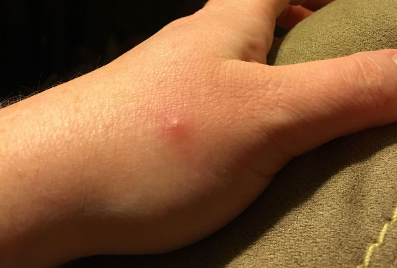 Bubițe pe mâini ca niște coșuri. Ce afecțiuni provoacă iritațiile și ...