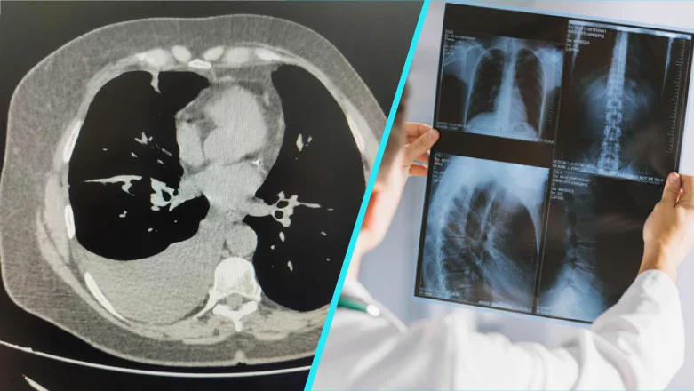 Ce simptome prezinți dacă ai apă la plămâni