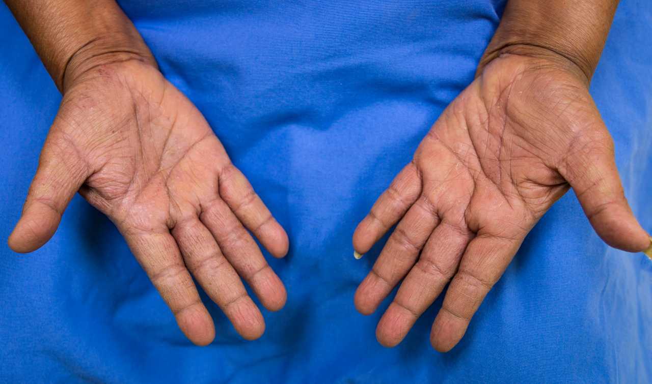 Ce este boala Addison și cum se manifestă