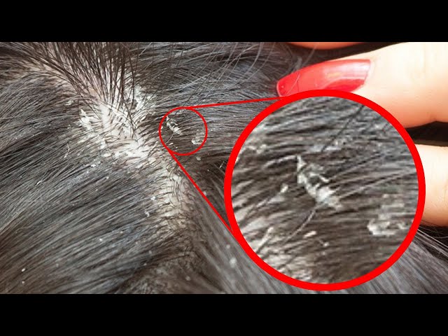 De la ce se fac păduchii de cap? Iată cum să scapi de ei