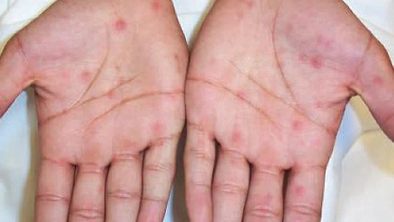 Sifilis – poze. Ce organe afectează această boală