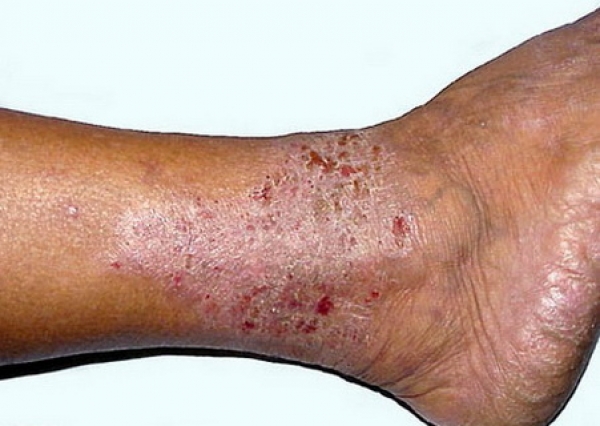 Ulcerul de gamba. Cauze si simptome • Buna Ziua Iasi • BZI.ro