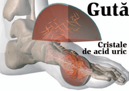 Tratament foarte bun pentru guta si articulatii bolnave • Buna Ziua ...