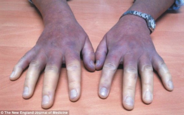 Sindromul Raynaud, boala care iti invineteste mainile la frig. Care ...